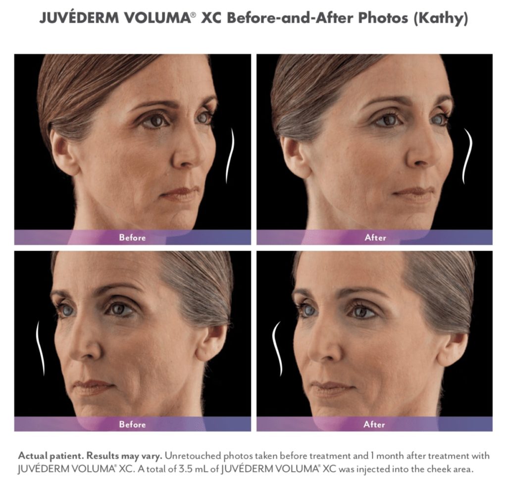 JUVÉDERM® Voluma XC in Bend, Eugene, Roseburg and Albany, OR ...